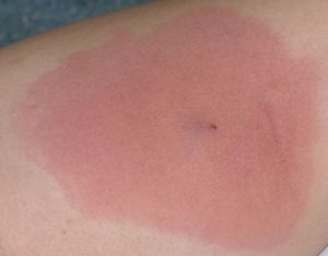 Correctional Nurse Clinical Update: Cellulitis